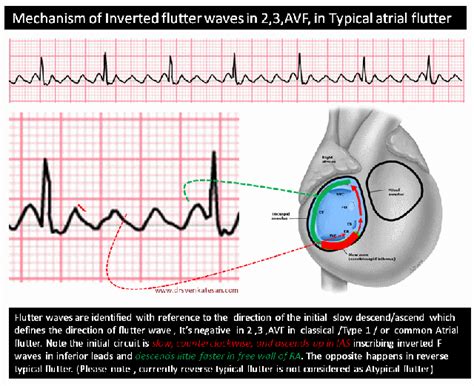 Atrial Flutter Sawtooth Ecg