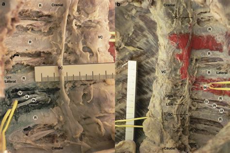 Deep Dissection Of Formalin Fixed Cadaver Anterolateral View Right Download Scientific
