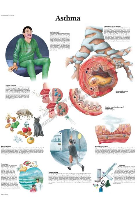 Asthma Chart Physiology Nursing Students Asthma
