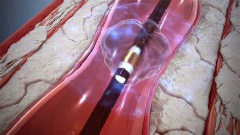 B57 Intervascular Lithotripsy System Scientific Animations