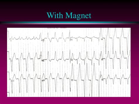 Ppt Pacemaker Malfunctions Powerpoint Presentation Free Download Id4310263