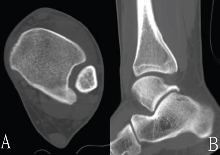 Subperiosteal Hematoma Of The Ankle Pmc