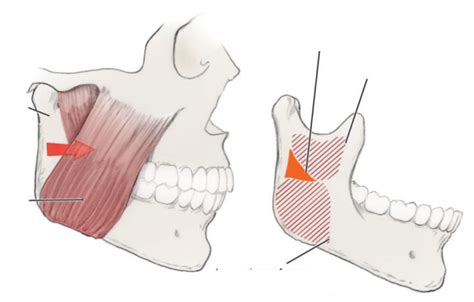 Diagram Of Masseteric Space Lateral View Quizlet