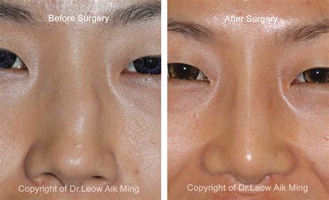 Septoplasty Before And After Below Are 3 Articles I