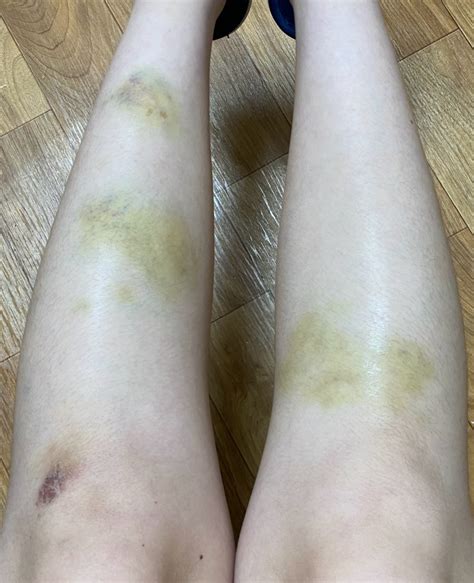 정강이에 멍이 들고 부었는데 병원에 가봐야 될까요 ㅣ 궁금할 땐 아하