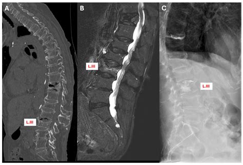 From Detection To Decision How Stir Sequence Mri Influences Treatment