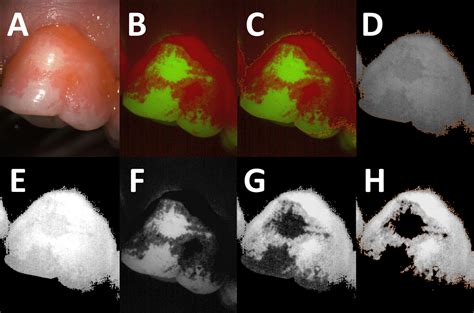 semi automated planimetric quantification of dental plaque using an