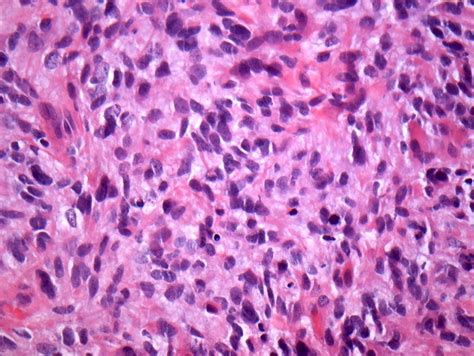 Pathology Outlines Diffuse Midline Glioma H3 K27 Altered