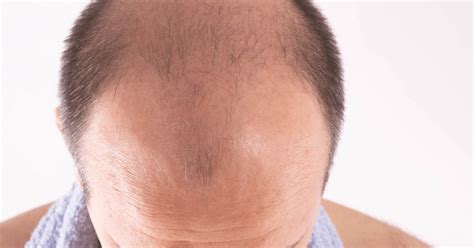 Male Pattern Baldness Stages Symptoms And Prevention Clinikally