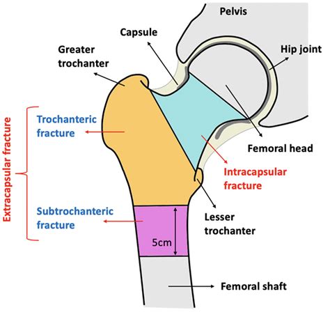 Intracapsular Vs Extracapsular Hip Fractures Geeky Medics Intracapsular Vs Extracapsular Hip Fractures Geeky Medics