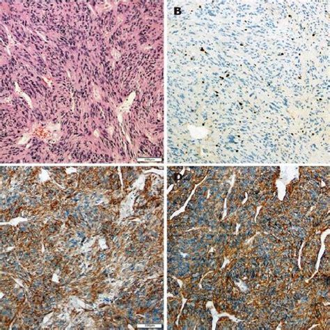 Histopathological Examination A Bundles Of Fusiform Cells In An Download Scientific Diagram
