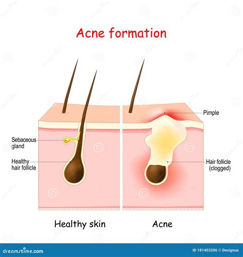 Pimple Under Skin Diagram