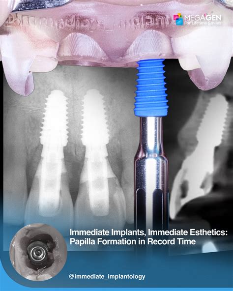 Megagen Implant Daegu