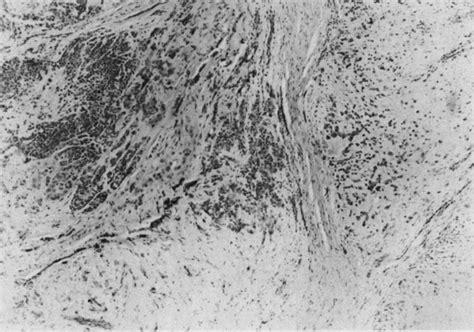 A Stroma Of Fibrous And Myxoid Tissue Download Scientific Diagram