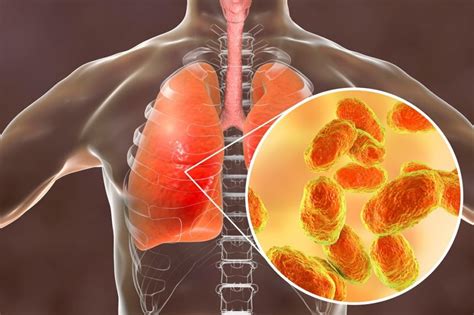 Gram Negative Bacteria Antibiotic Susceptibility For Pneumonia In The
