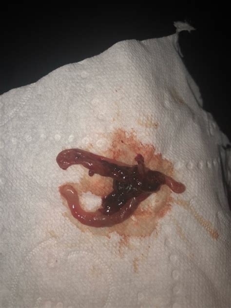 TMI Implantation Bleeding Miscarriage Or Blood Clot Glow Community