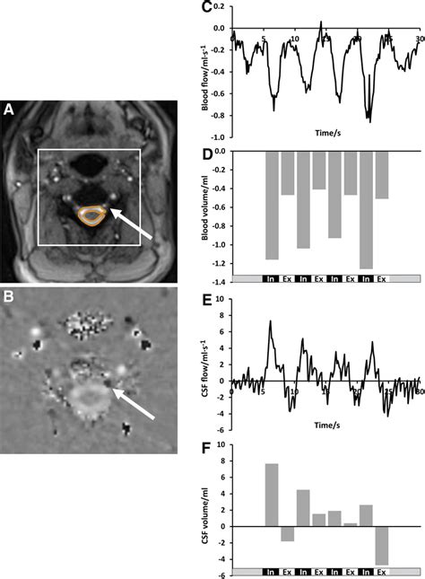Venous Blood Flow And Simultaneous CSF Flow At C3 Left Magnitude Download Scientific Diagram