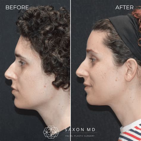 How To Get A Smaller Forehead Dr Sarah Saxon