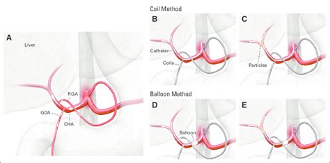 Comparison Of Coil Embolization And Balloon Occlusion Techniques For Download Scientific