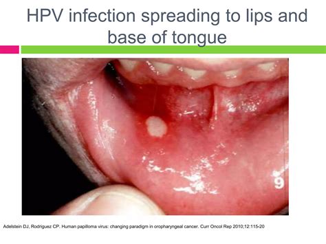 Latest Presentation Of Hpv In Head And Neck Pptx