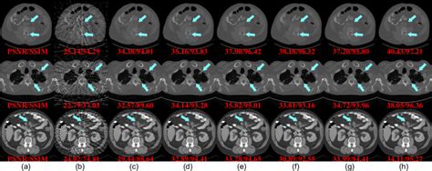 Visual Comparison Of State Of The Art Methods On Deeplesion Dataset Download Scientific