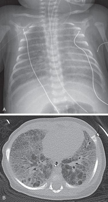 Diffuse Lung Disease Clinical Tree