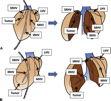 Tape Guided Right Posterior Sectionectomy Of The Liver For Tumors