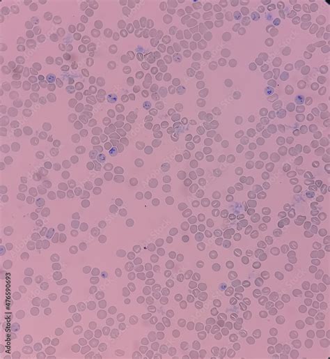 Reticulocyte Count Under Microscope 100x Methylene Blue Stainingreticulocyte Count From Blood Reticulocyte Count Under Microscope 100x Methylene Blue Stainingreticulocyte Count From Blood