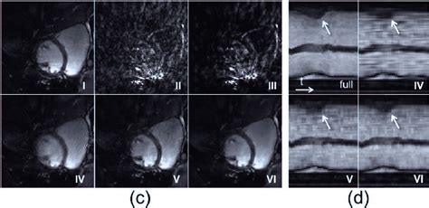 Figure 1 From Motion Compensated Compressed Sensing Dynamic Mri With Low Rank Patch Based
