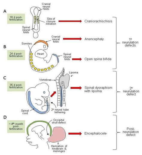 Neural Tube Defects Neuropedia Neuropathology