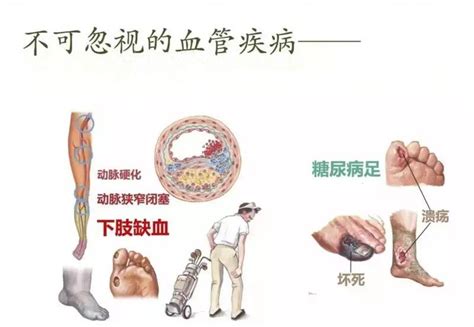 浅谈糖尿病足的分级和分级管理 知乎