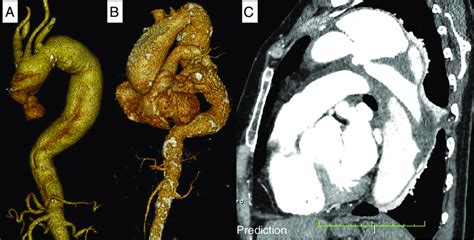 Tc Preoperatorio A Aneurisma De Aorta Ascendente Distal Cayado