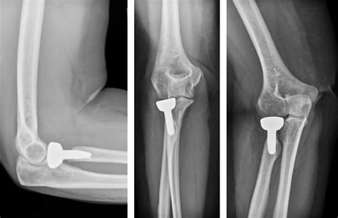 Modern Radial Head Arthroplasty For Terrible Triad Fracture Dislocations A Retrospective Case