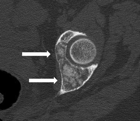 Axial Noncontrast Ct Image Of The Left Acetabulum In Bone Window Soon Download Scientific