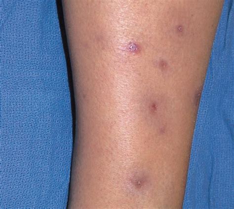 Staph Infection Scar Pictures At Shirley Vining Blog
