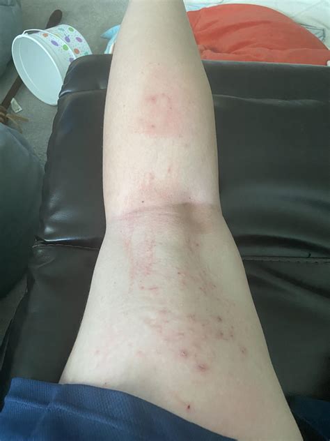Poison Oak On Back