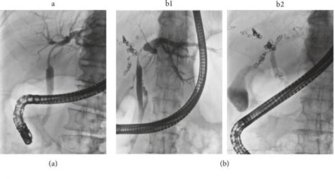 Figure 1 From Comparison Of An Inside Stent And A Fully Covered Self