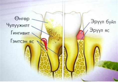 Terguundent шүдний эмнэлэг Шүдээ сайтар угааж цэвэрлэхгүй бол шүдний гадаргуу дээр наалдсан