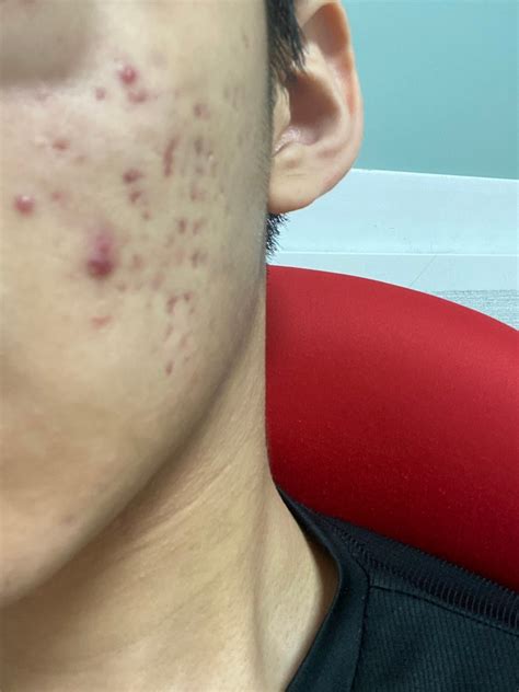 여드름 피 고임 지식in