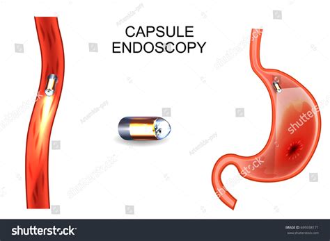 Vector Illustration Capsule Endoscopy Egd Gastroenterology Stock Vector