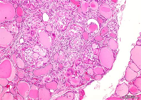 Pathology Outlines Palpation Thyroiditis
