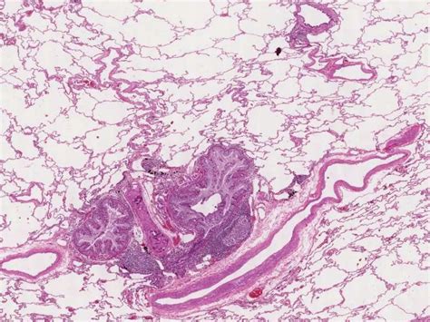 Ch15 Lung Ppt Based On Obstructive Lung Disease Ppt