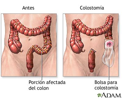Colostomía Serie—cuidados Postoperatorios Medlineplus Enciclopedia