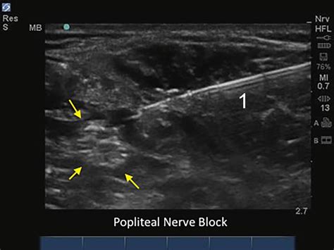M Turbo Popliteal Nerve Block With Needle Image Sonosite Institute For Point Of Care Ultrasound