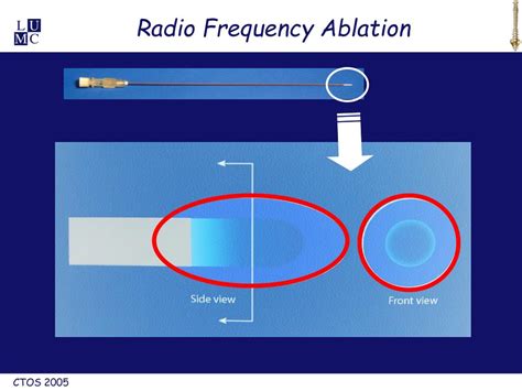 Ppt Ct Guided Radiofrequency Ablation In 24 Patients With Spinal Osteoid Osteomas Powerpoint