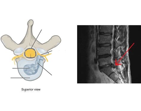 Herniated Intervertebral Disc Quiz
