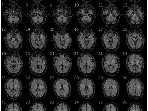 Machine And Deep Learning Approaches For Resting State Fmri Data Of