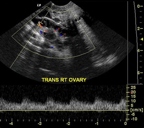 Pearls And Pitfalls In Diagnosis Of Ovarian Torsionradiographics