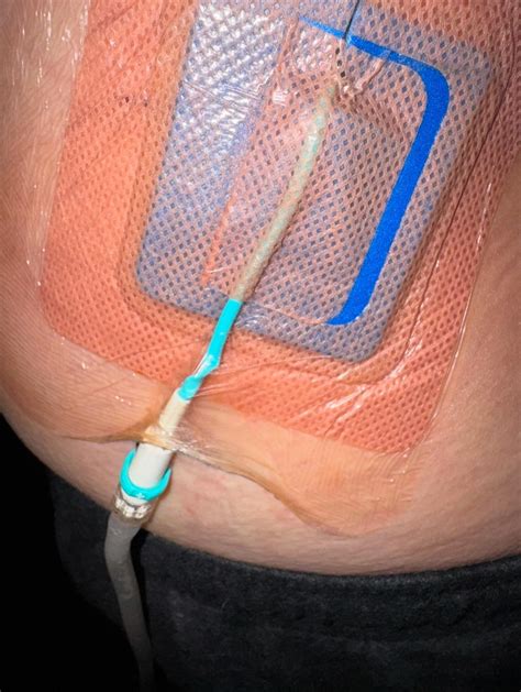 Stoma Nephrostomy