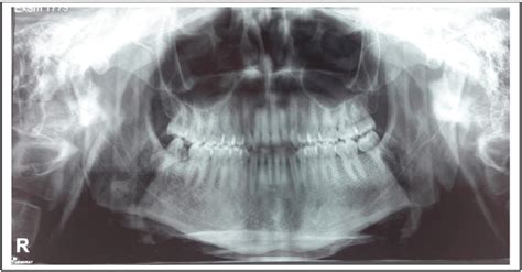 Preoperative Radiograph Showing The Impacted Mandibular Right Third